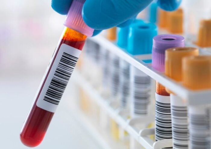 Bazofil Aktivasyon Testi (BAT) Nedir, Nasıl Yapılır?